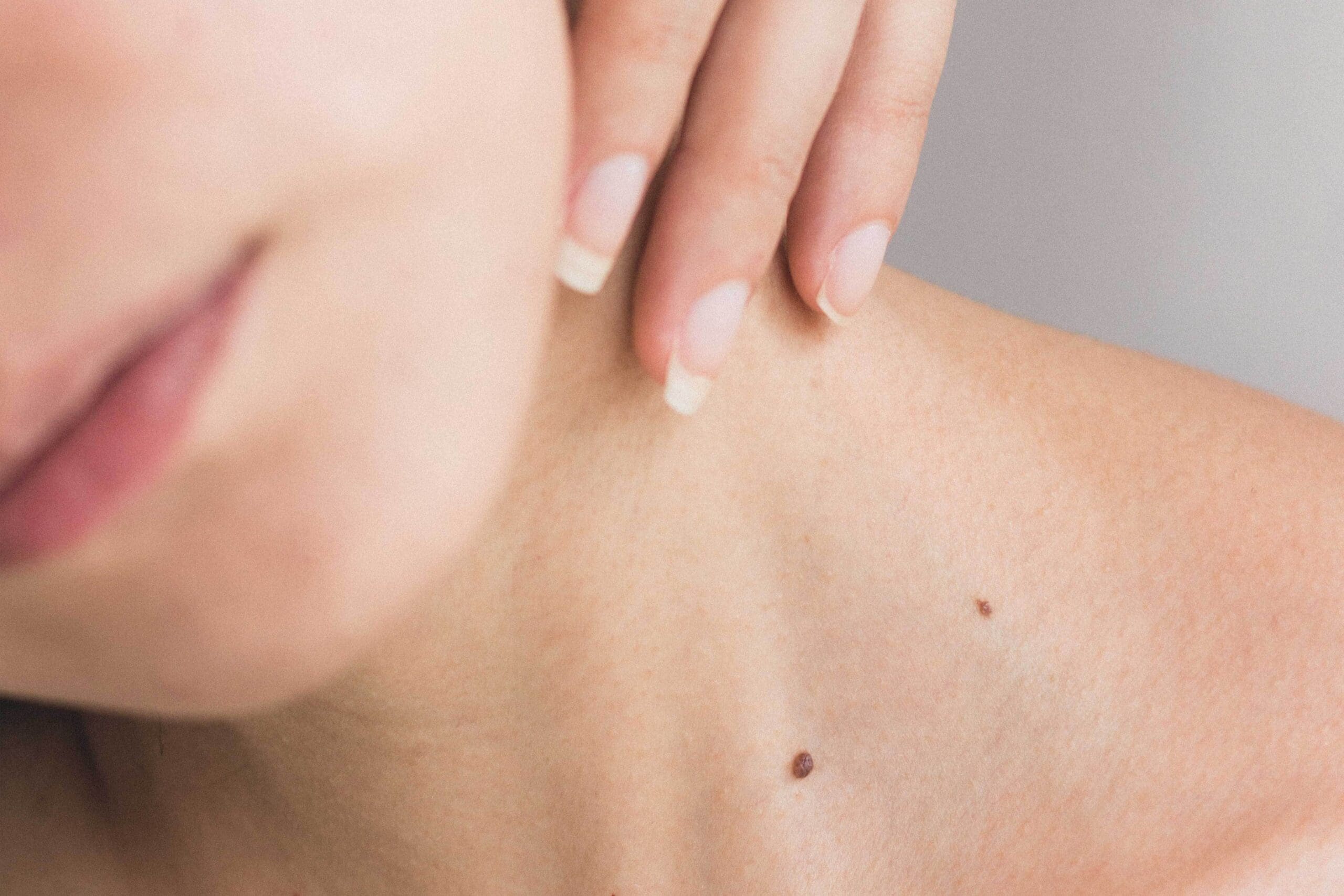"I Have a New Mole": Causes and When to See a Dermatologist - All ...
